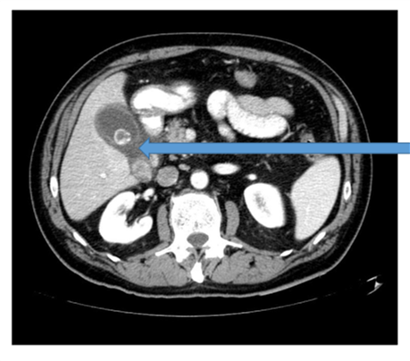 ilearn.courses.med.fiu.edu - /published/Gallbladder_Clinical_Anatomy ...